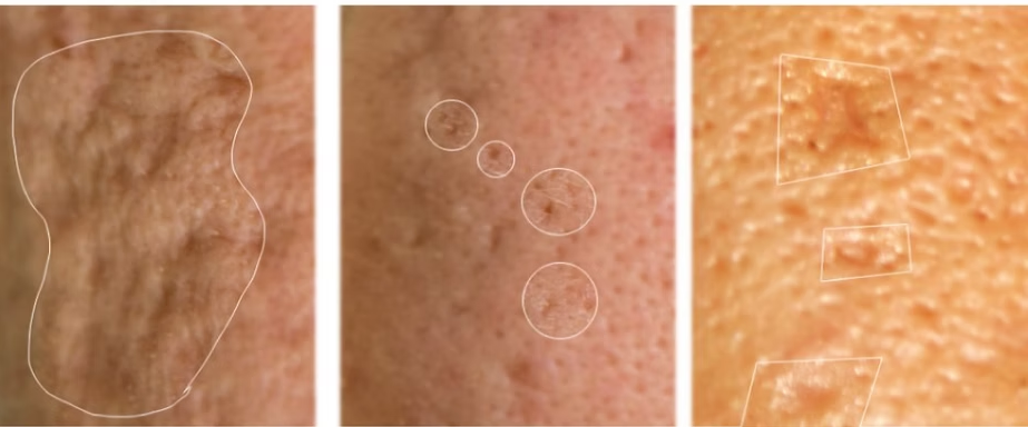 Como tratar marcas de acne: o que funciona de verdade?